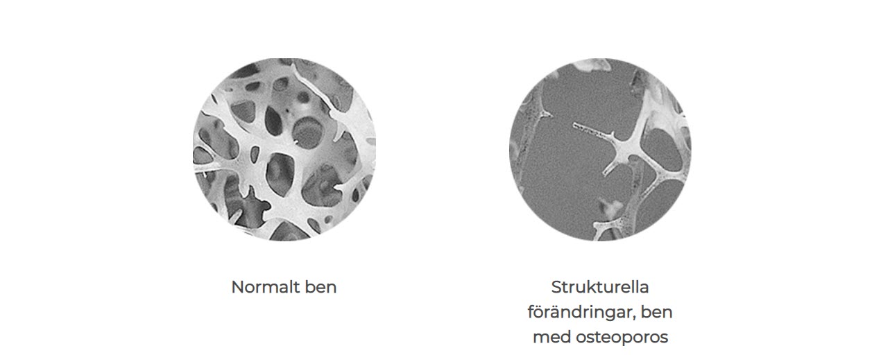 Osteoporos/benskörhet
